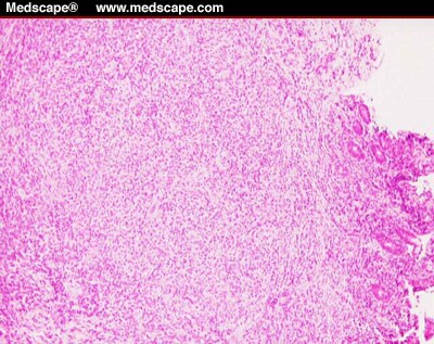 Intestinal Transplantation