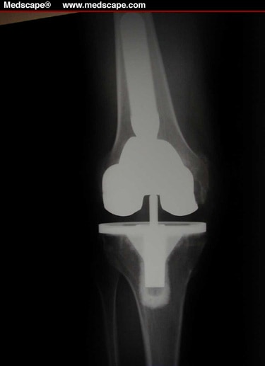Surgical Challenges in Revision Total Knee Replacement