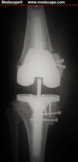 Surgical Challenges in Revision Total Knee Replacement