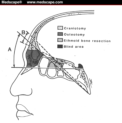 The Role of Fibrin Sealants in Cranial-Base Surgery