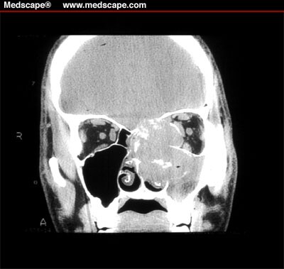 The Role of Fibrin Sealants in Cranial-Base Surgery