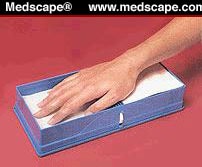 Hyperhidrosis: Current Understanding, Current Therapy