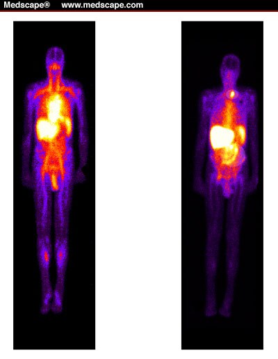 Radioimmunotherapy: New Option for Managing Indolent Non-Hodgkin's Lymphoma