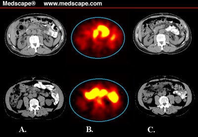Radioimmunotherapy: New Option for Managing Indolent Non-Hodgkin's Lymphoma