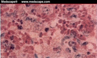 Effect of a Catabolic State With Involuntary Weight Loss on Acute and ...