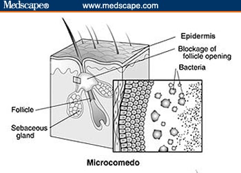 Acne and Rosacea: Differential Diagnosis and Treatment in the Primary ...