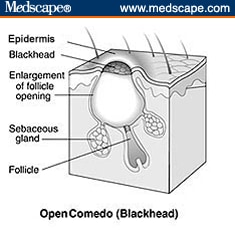 Acne and Rosacea: Differential Diagnosis and Treatment in the Primary ...