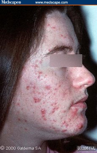 Acne and Rosacea: Differential Diagnosis and Treatment in the Primary ...