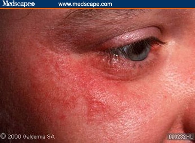 Acne and Rosacea: Differential Diagnosis and Treatment in the Primary ...