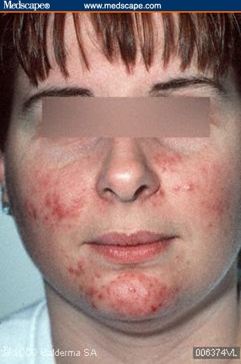 Acne and Rosacea: Differential Diagnosis and Treatment in the Primary ...