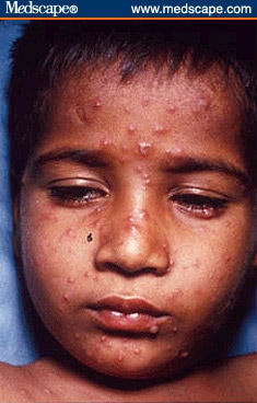 Medscape Personal Professor: Smallpox