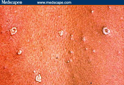 Medscape Personal Professor: Smallpox