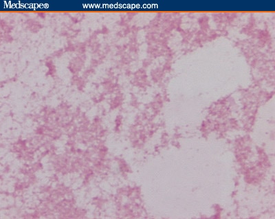 Medscape Personal Professor: Tularemia