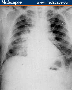 Pneumonic Tularemia The Causes And Complications From Tularemia | CCCH