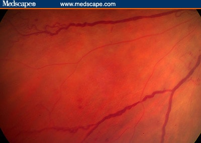 Classification of Diabetic Retinopathy: A Proposed International ...