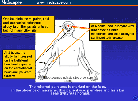 Migraine Headaches and Allodynia: Early Use of Triptans to Improve Outcome