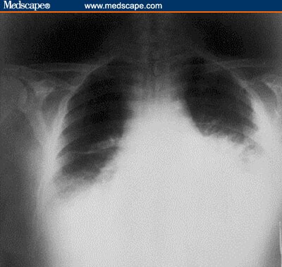 Medscape Personal Professor: Anthrax