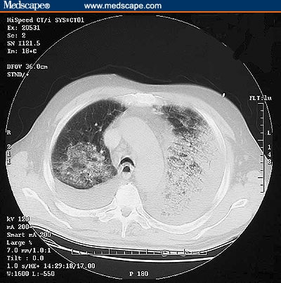 Medscape Personal Professor: Anthrax