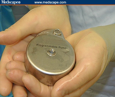 Interventional Management of Cancer Pain