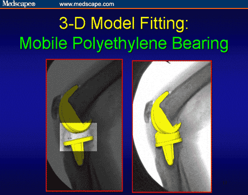 Rotating-Platform Total Knee Arthroplasty