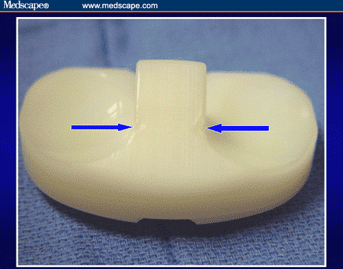 Rotating-Platform Total Knee Arthroplasty