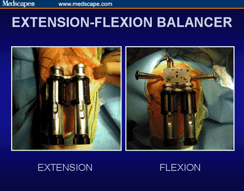 Rotating-Platform Total Knee Arthroplasty
