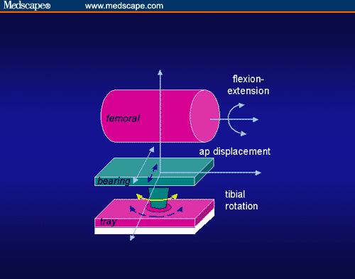 Rotating-Platform Total Knee Arthroplasty