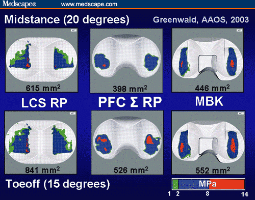 Rotating-Platform Total Knee Arthroplasty