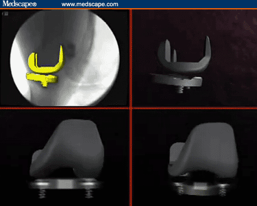 Rotating-Platform Total Knee Arthroplasty