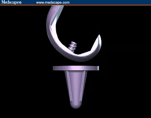 Rotating-Platform Total Knee Arthroplasty