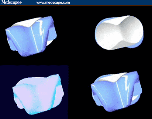 Rotating-Platform Total Knee Arthroplasty