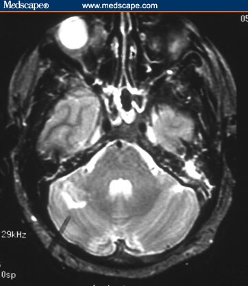 Management of Posttransplant Malignancies