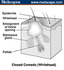 Acne Comes of Age: Treatment Approaches for the Adult Population