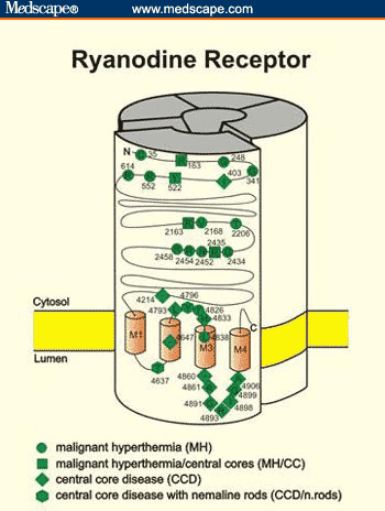 Malignant Hyperthermia