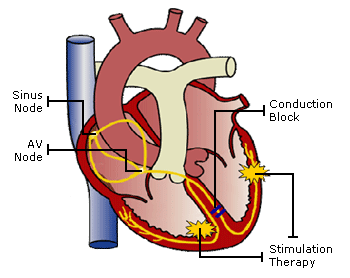 Cardiac Resynchronization Therapy