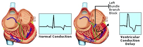 Cardiac Resynchronization Therapy