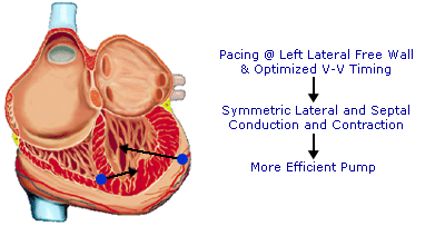 Cardiac Resynchronization Therapy