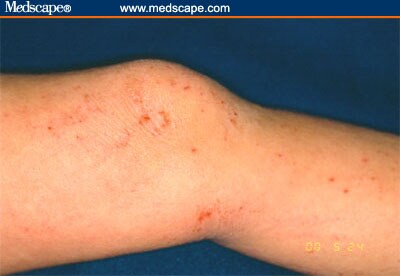 A Kindergarten Teacher With Lifelong Atopic Dermatitis