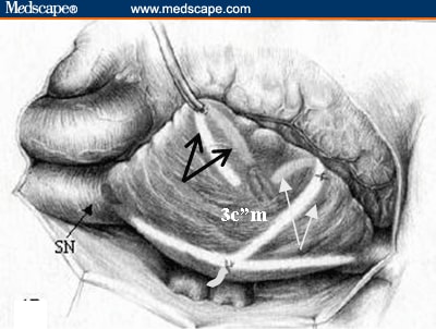 Surgical Ablation of Atrial Fibrillation: The Maze Procedure and Prevention of Stroke
