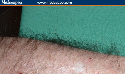 Surgical Care Improvement Project (SCIP) Module 1: Infection Prevention