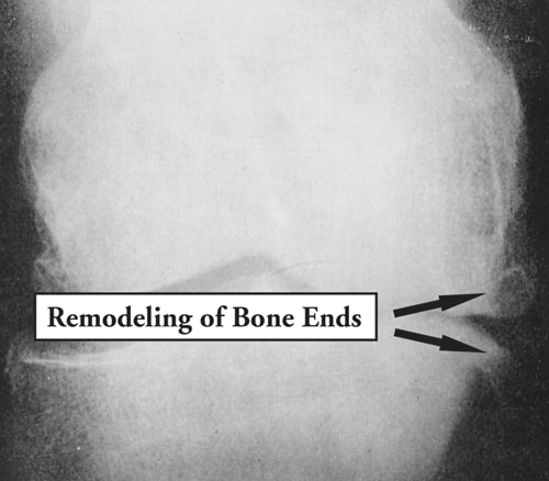 Management of Osteoarthritis Knee Pain: The State of the Science