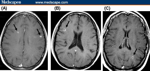 The Role of MRI in Multiple Sclerosis Diagnosis and Management