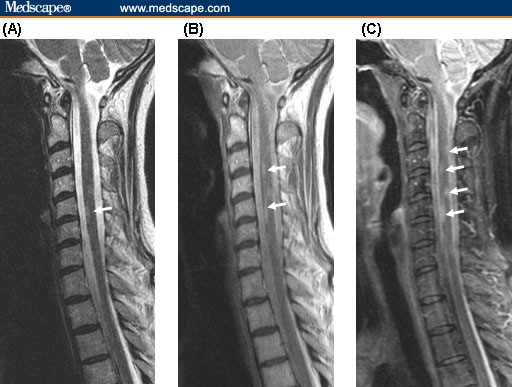 The Role of MRI in Multiple Sclerosis Diagnosis and Management