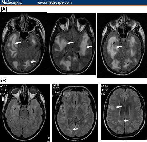 The Role of MRI in Multiple Sclerosis Diagnosis and Management