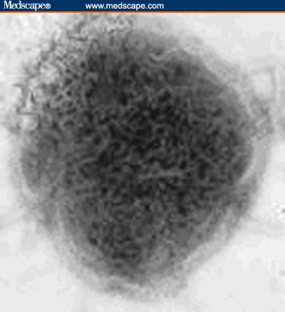 Vaccine-Preventable Illnesses