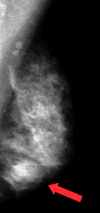 Breast Cancer Biopsy Methods