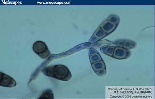 Invasive Fungal Infections