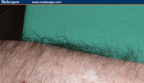 Surgical Care Infection Prevention Update