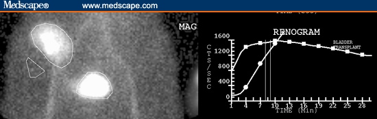 Clinical Applications of Tc-99m MAG3 Renography