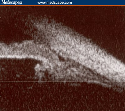 Primary Angle-Closure Glaucoma